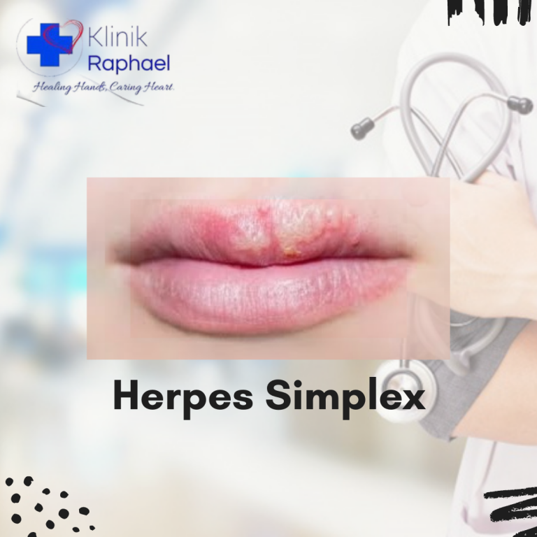 Herpes Simplex – Gejala Penyebab dan Pengobatan