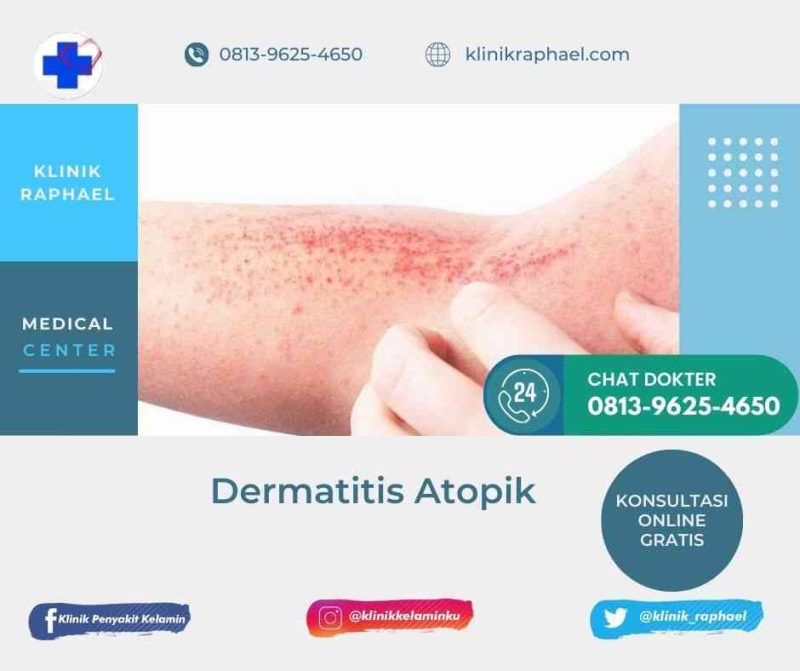 Mengobati Gatal Akibat Dermatitis Atopik - Klinik Andrologi